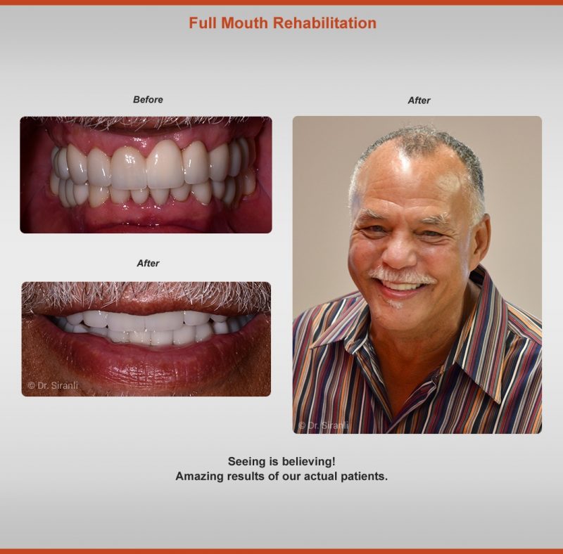 Smile Makeovers Washington DC - Teeth Whitening, Invisalign, Implants